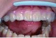 GC Aligner Connect | GC Ortho